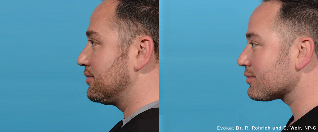 Evoke by InMode - Skin Care | Burlington Medical Aesthetics